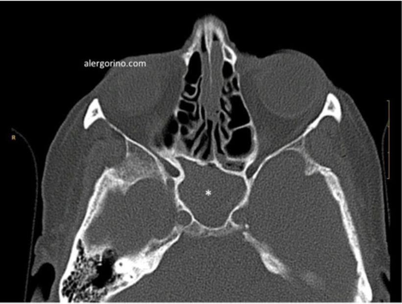 Sinusitis crónica | Centre Mèdic Teknon